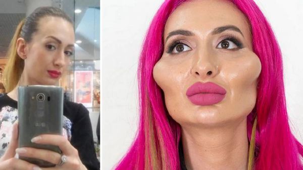 Berhabis Ribuan Pound Buat Muka, Model Terkenal Tak Kisah Pipi Besar ...