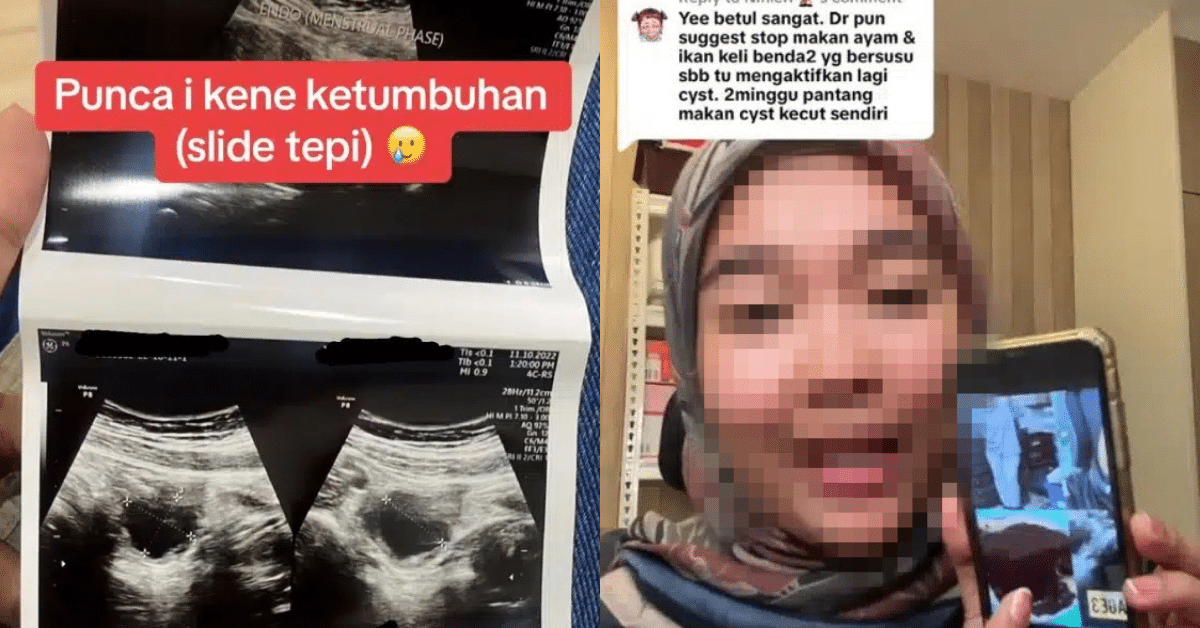 Gemar Makan Ayam Setiap Hari, Wanita Menghidapi Cyst Stage 3 Dan Hampir ...